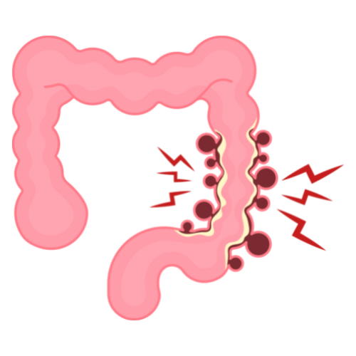 Chronic Inflammatory Bowel Disease (IBD) - OMNi-BiOTiC®