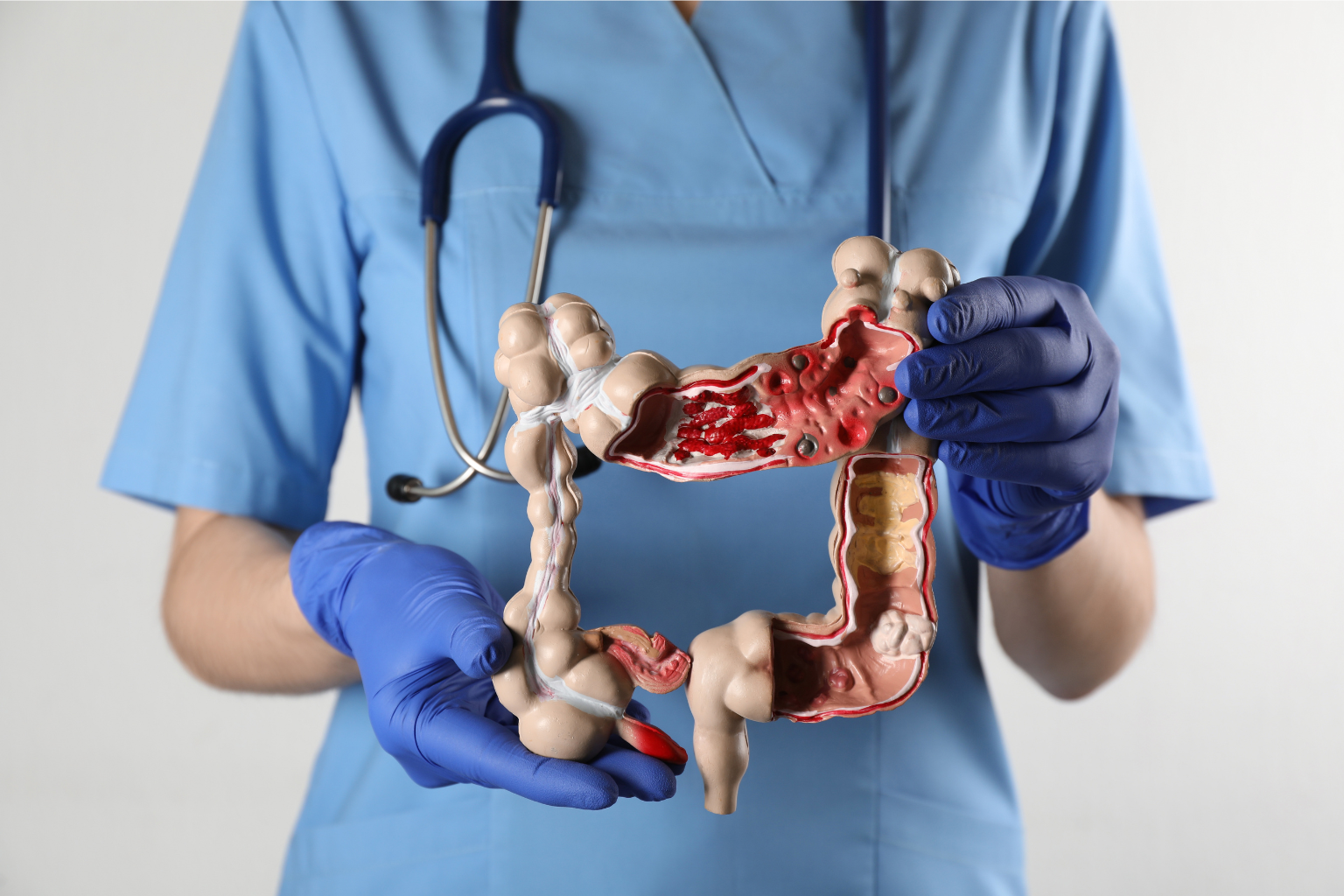 Enfermedad de Crohn: síntomas, causas, tratamiento