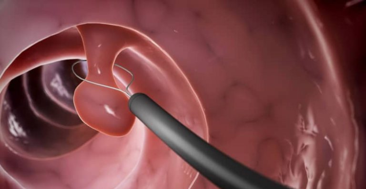 Coloscopie et microbiote - OMNi-BiOTiC® - Science et qualité